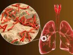 Diagnóstico Rápido da Tuberculose com TRM-TB e PCR