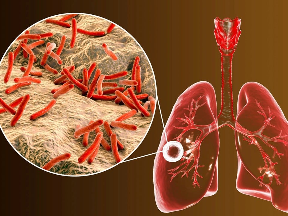 Diagnóstico Rápido da Tuberculose com TRM-TB e PCR